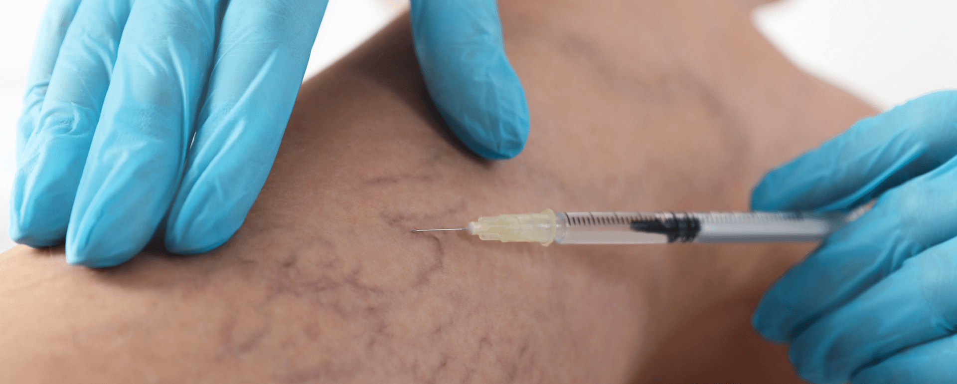 Spider veins treatment at Mayam Aestetic | reduce thread veins and ...